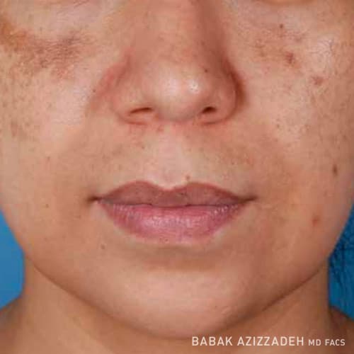 Nasolabial Flaps For Nasal Reconstruction Pros And Cons